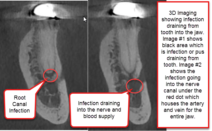  Root Canal Infections How We Uncover Long Standing Infections Using 3D Imaging 