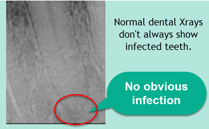 Hidden Root Canal Infections and How to Find Them - Integrative ...