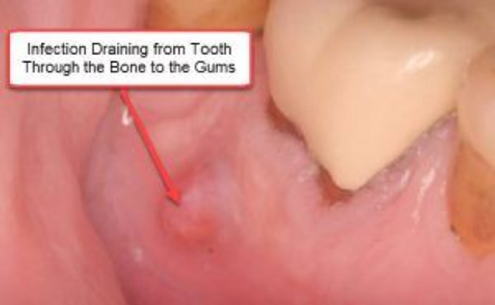 What Causes Root Canal Infections And Failure Integrative Dentistry