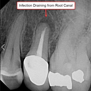 How to Resolve a Root Canal Infection - A Pardigm Shift - Integrative ...
